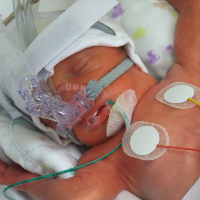 What is classed as Premature Birth: Understanding Preterm Labour and ...